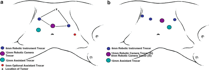 Robotic Partial Nephrectomy Transperitoneal Technique Abdominal Key