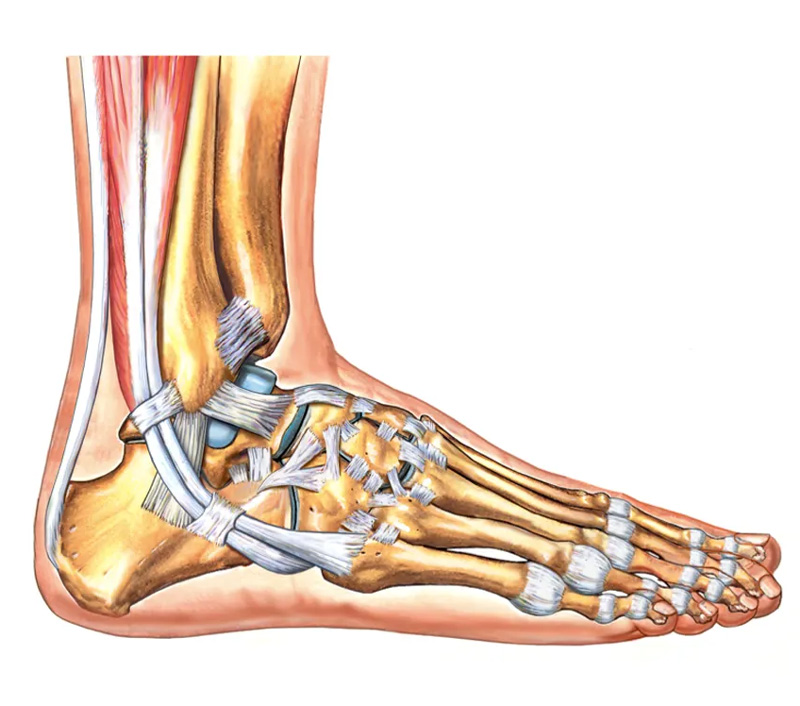 Insertional Achilles Tendinitis Alexis E Dixon Md