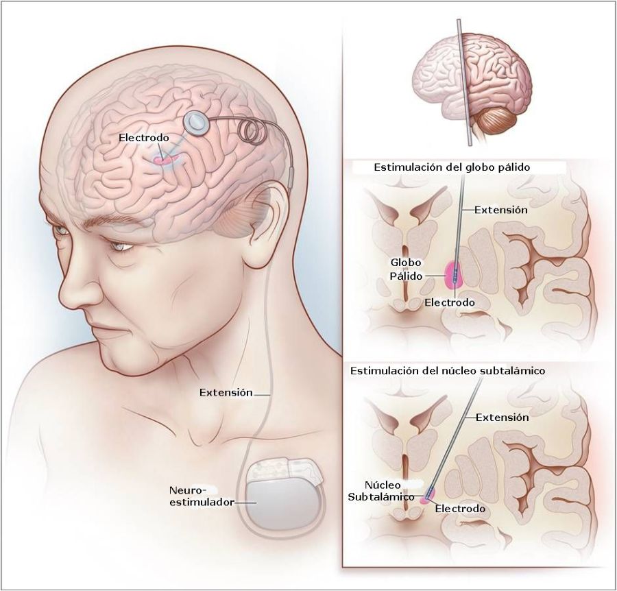 Estimulación Cerebral Profunda Una Mejora De Los Síntomas De La