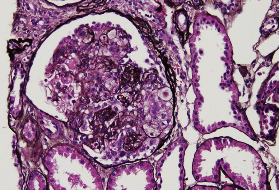 Atlas Of Renal Pathology Ii Ajkd Blog