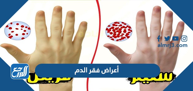 أعراض فقر الدم وأسبابه وطرق علاجه موقع المرجع