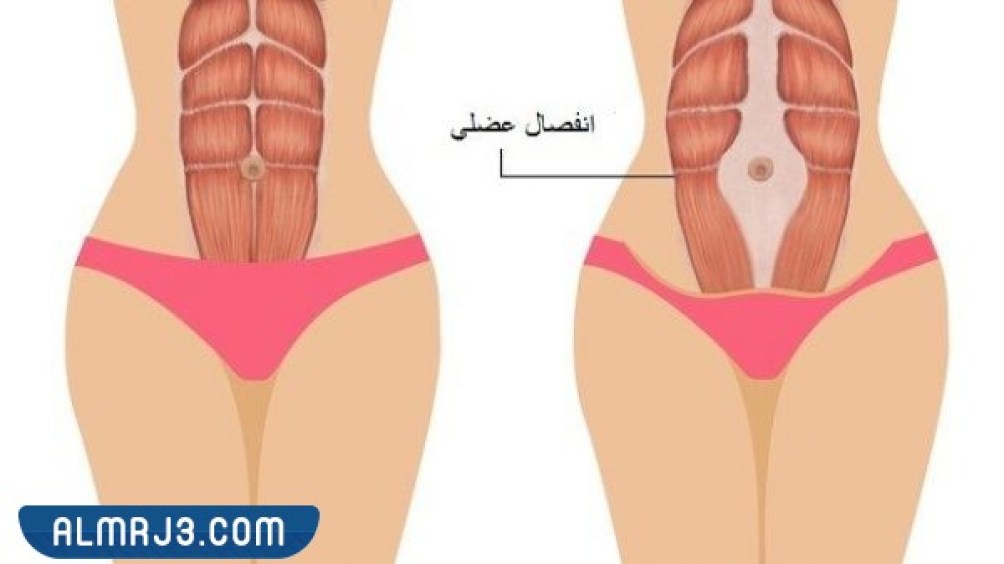 شد البطن بعد الولادة القيصرية بالصور موقع المرجع