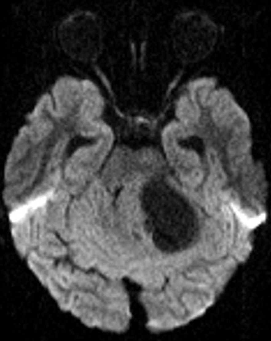 Primary Pediatric Posterior Fossa Tumors An Illustrative Review Arrs