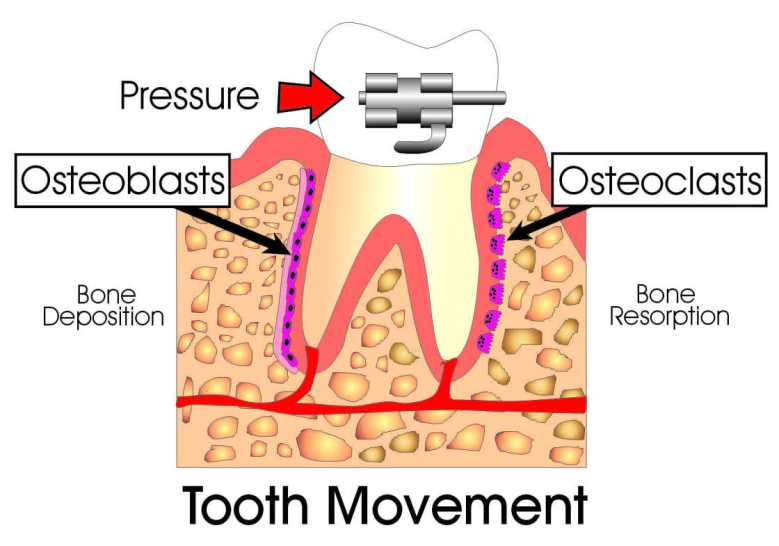 How Do Braces Work Ask An