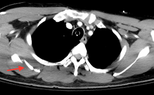 Cureus Persistent Shoulder Pain Due To A Suprascapular Nerve Injury