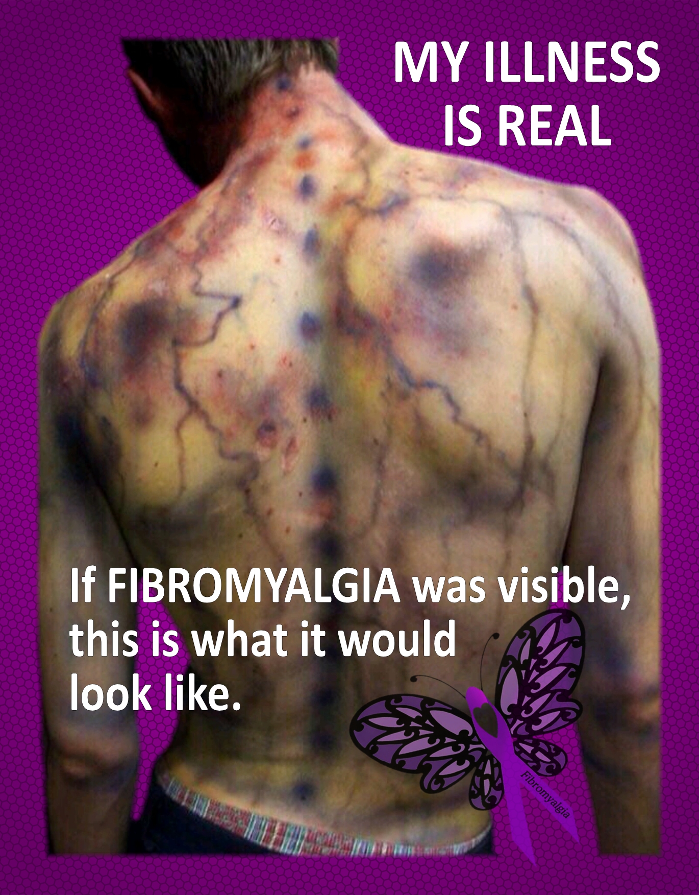 Fibromyalgia Back In Action