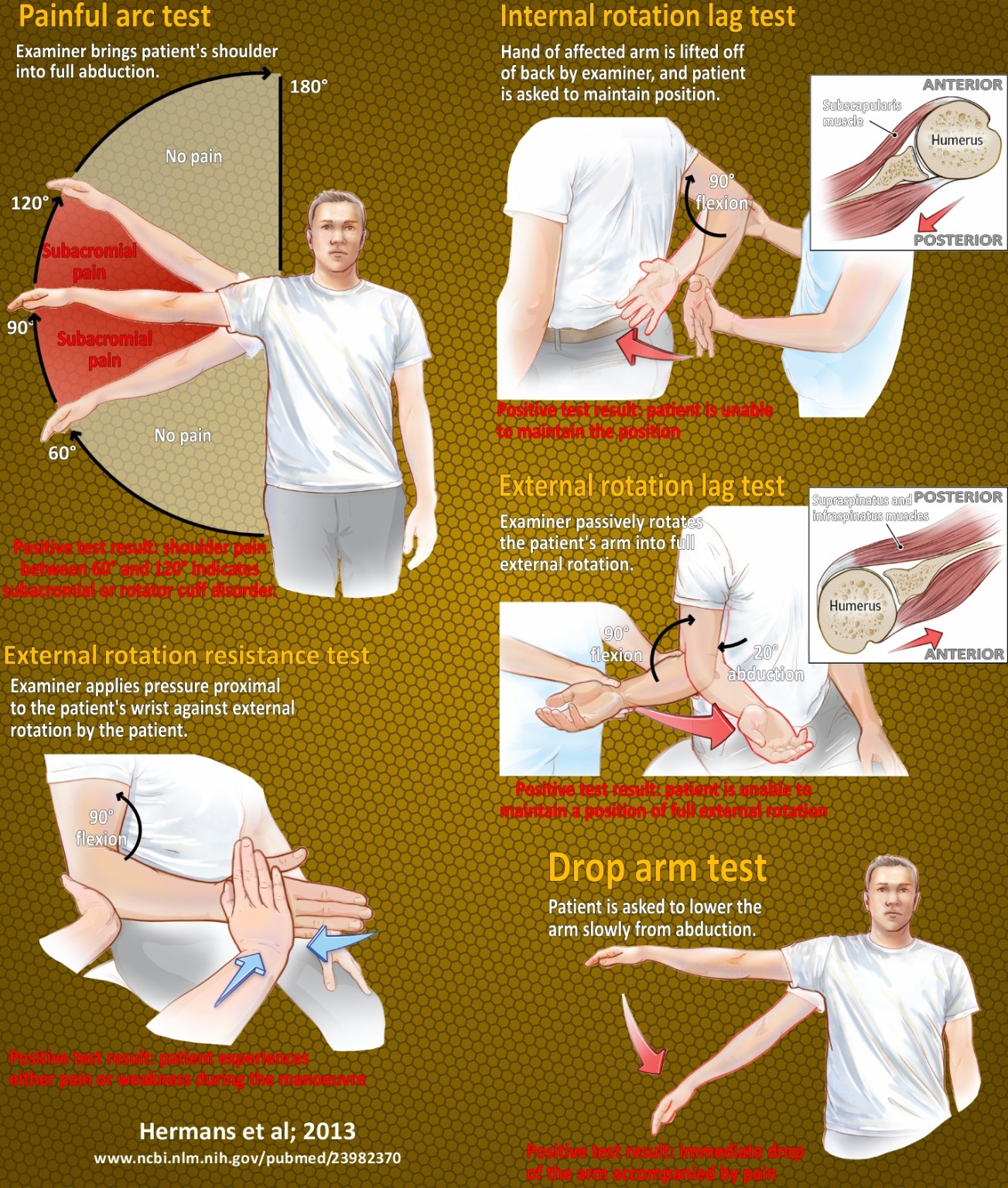 Impingement Syndrome Back In Action