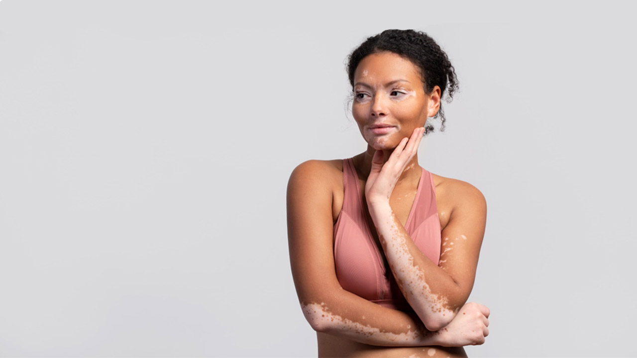 Mês Do Vitiligo Entenda As Causas Sintomas E Tratamentos Da Doença