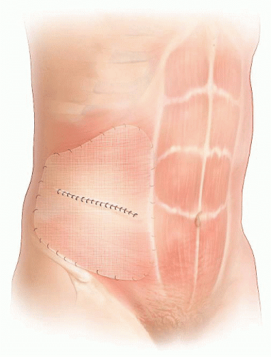 Incisional Hernia Open Approaches Basicmedical Key