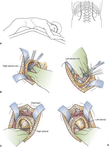 Laparoscopic Repair Of Ventral Hernias Basicmedical Key