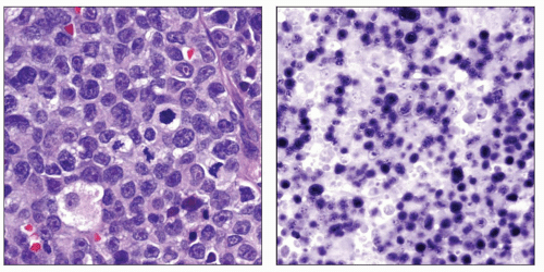 Primary Cutaneous Diffuse Large B Cell Lymphoma Leg Type