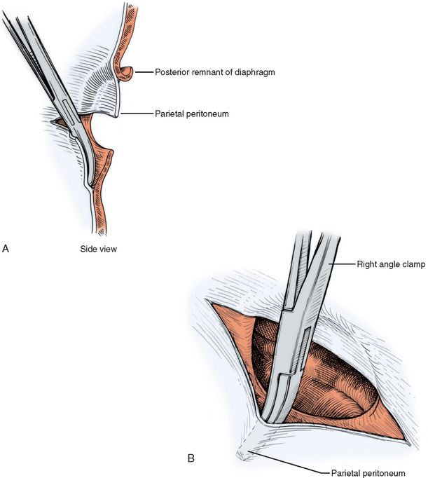 Congenital Diaphragmatic Hernia Basicmedical Key