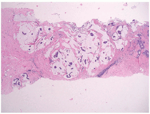 Invasive Carcinoma Special Types And Important Considerations