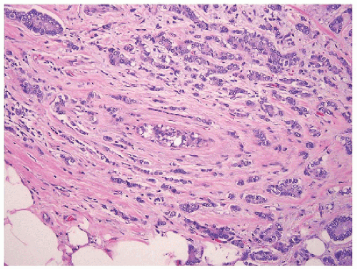 Invasive Carcinoma Special Types And Important Considerations