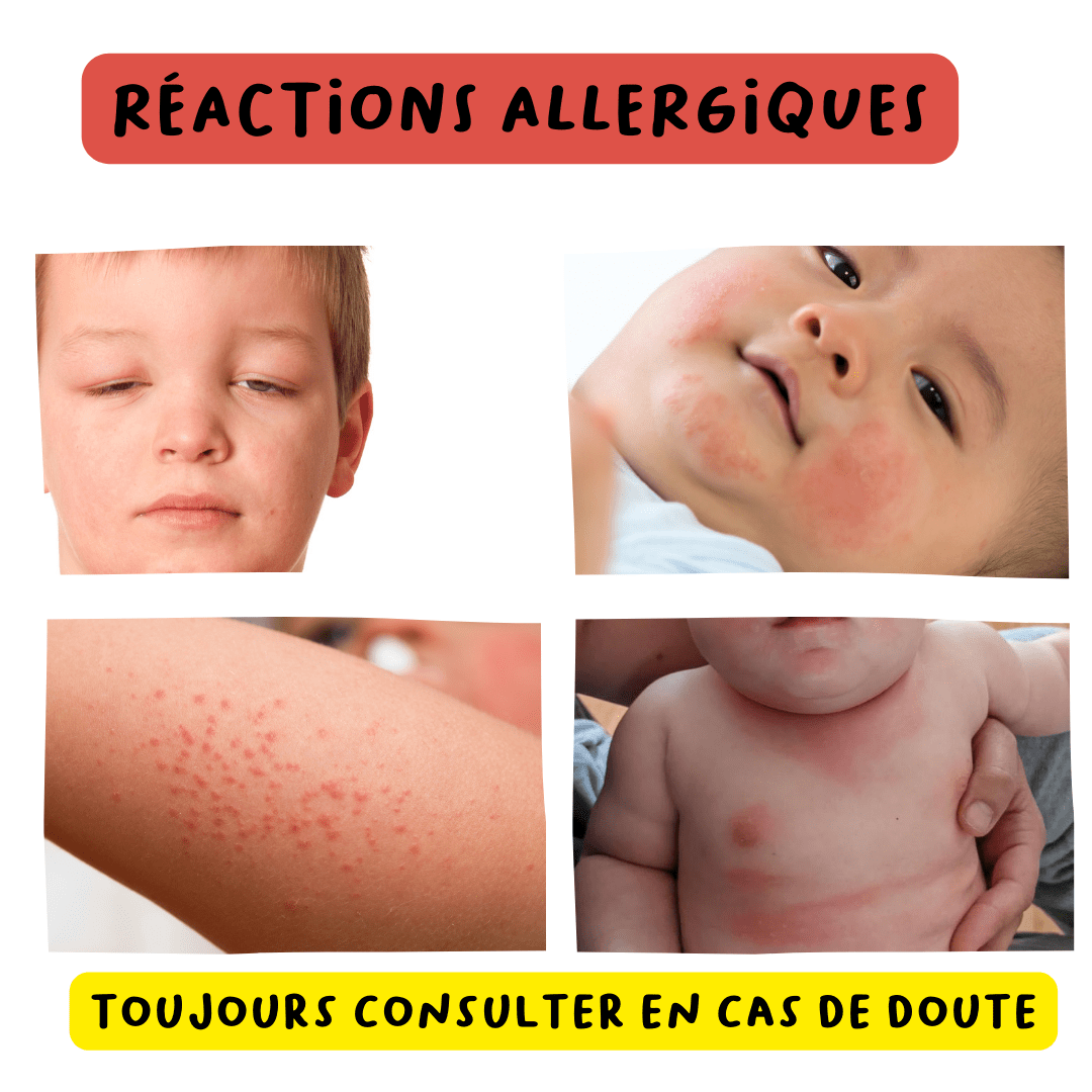 Réactions Allergiques Bébé Mange Seul