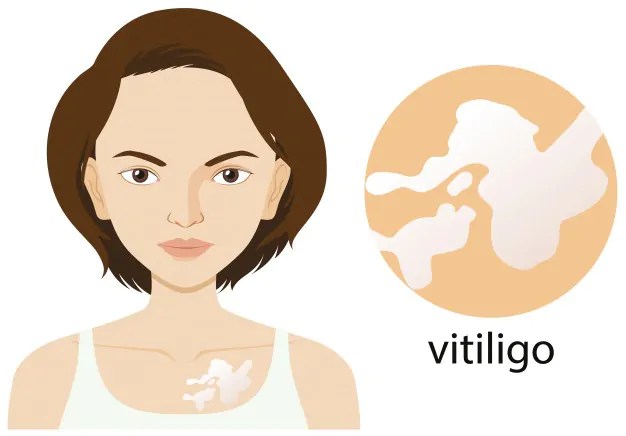 Vitiligo Tem Cura Saiba O Que é Suas Causas Sintomas E Tratamento