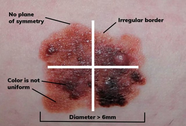 Cancerous Mole Vs Normal Mole