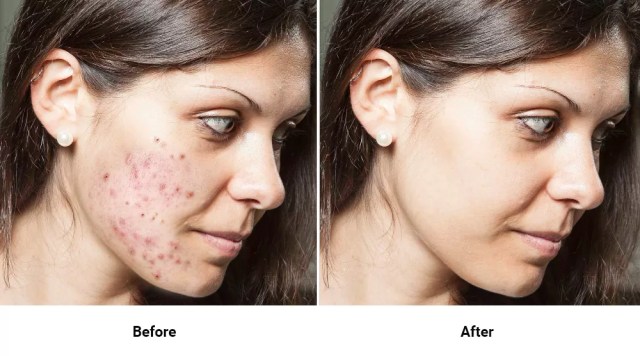 Accutane Before And After Body