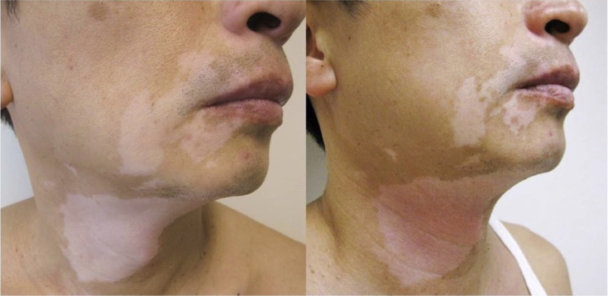 Opzelura New Treatment For Vitiligo • Biopharma Media