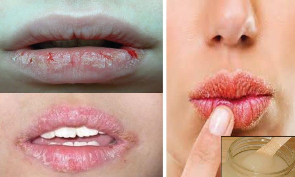 How To Cure Chapped Lips At Home