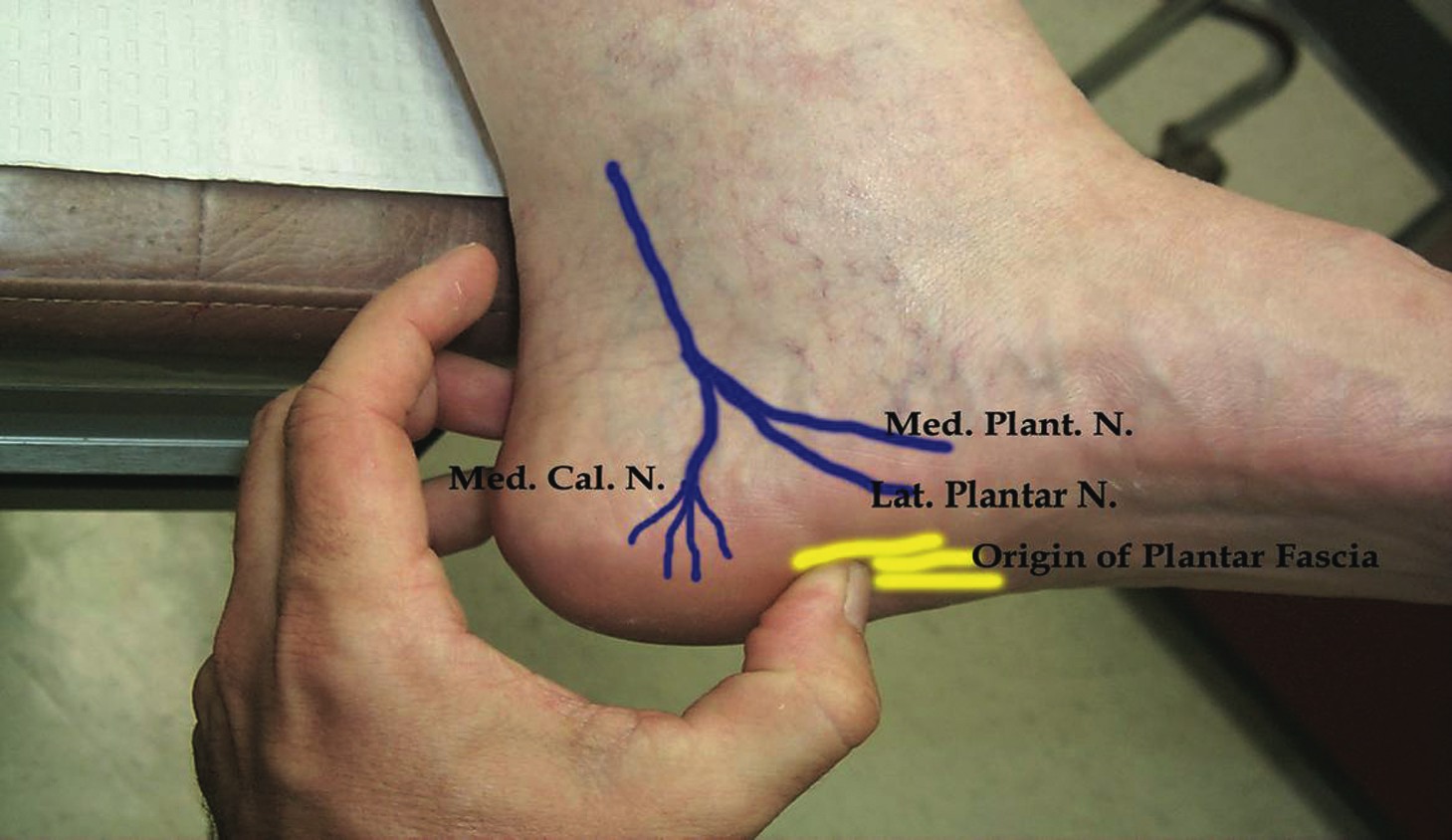 Baxters Nerve Entrapment Healing Those Painful Heels Almawi