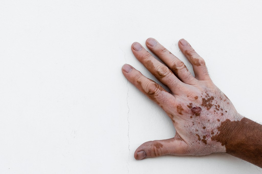 Vitiligo O Que é Causas Sintomas E Tratamento Blog Nsulta
