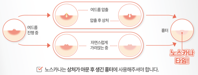 노스카나겔 여드름 흉터 치료제 효과 효능 사용법 가격 정보 시간여행