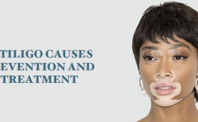Vitiligo Causes Symptoms And Treatment Otosection