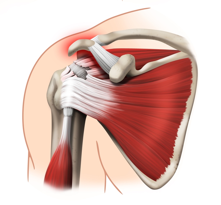 Torn Rotator Cuff Symptoms Diagnosis And Treatment Op