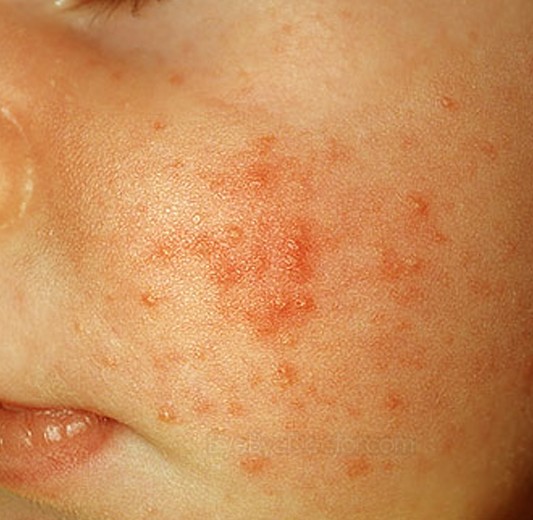 Big Red Itchy Bumps On Skin Prnso