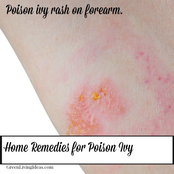 Home Remedies For Poison Ivy How To Avoid It