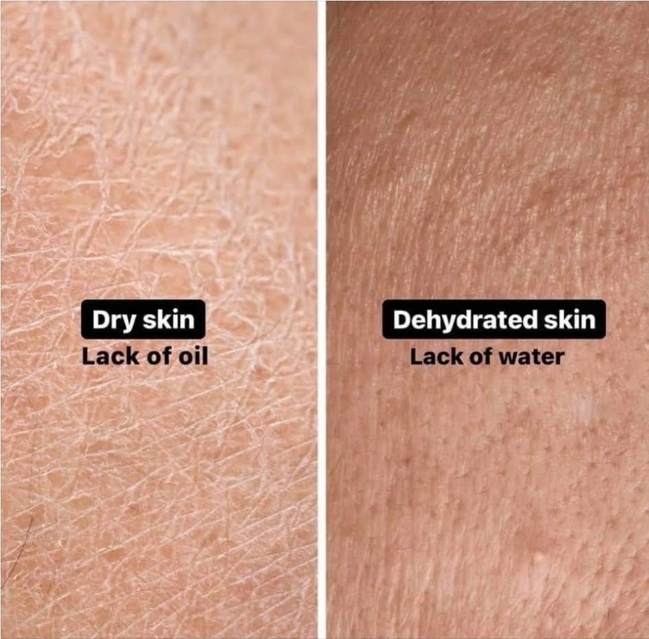 Dry Skin Vs Dehydrated Skin Whats The Difference Glowing With Eve