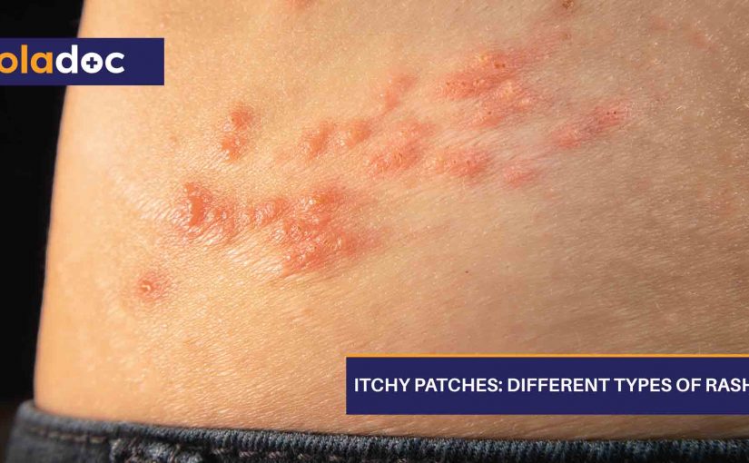 Different Kinds Of Rash What S That Rash With Pictures Queensland