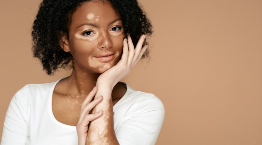 O Que é Vitiligo Saiba Identificar O Problema E Conheça Principais