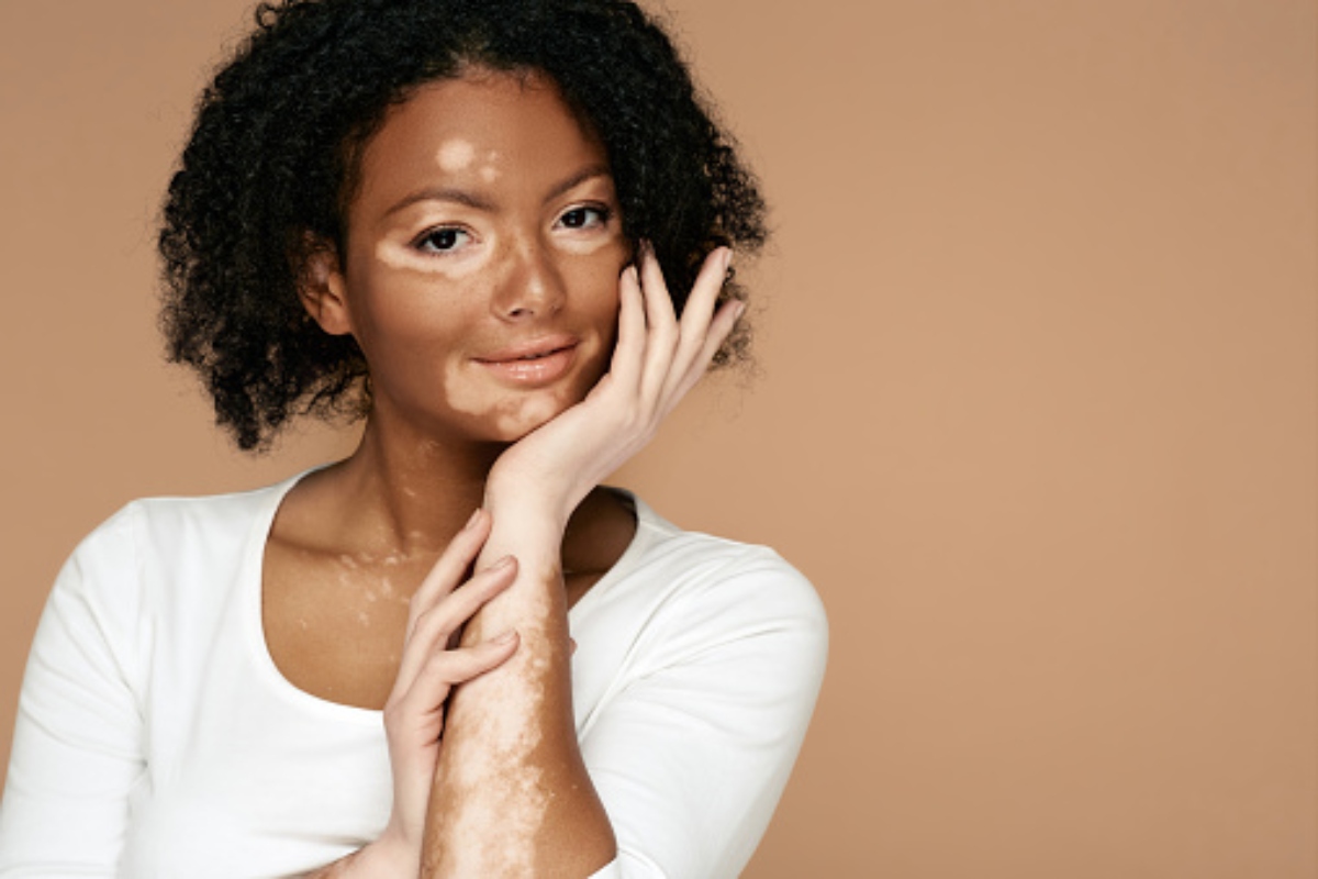 O Que é Vitiligo Saiba Identificar O Problema E Conheça Principais