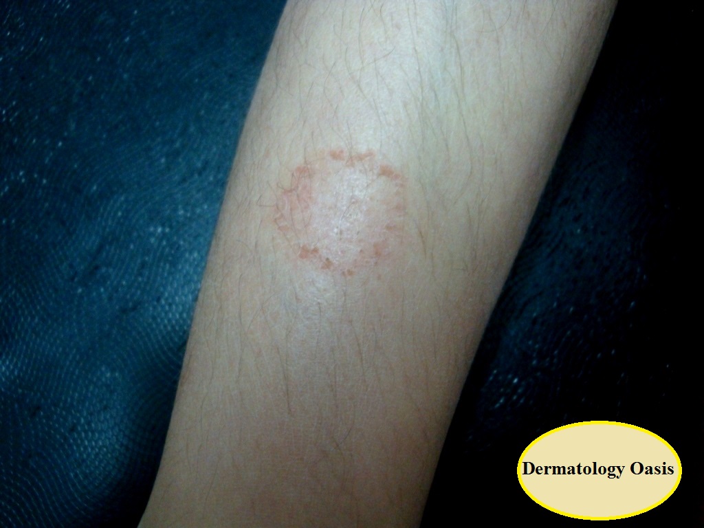 Nummular Dermatitis Nummular Eczema