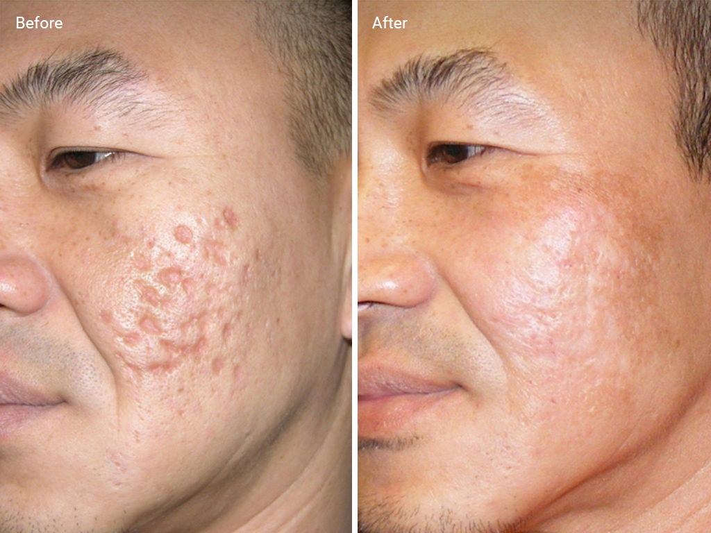 Laser Skin Resurfacing For Acne Scars Efficacy Before And Afters Cost