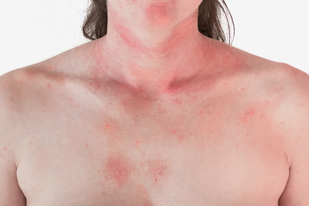 Exfoliative Dermatitis Definition Causes Treatments And More