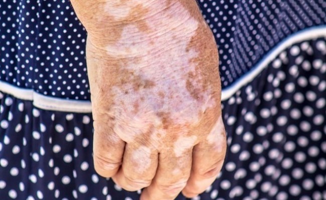 Vitiligo O Que E Causas Tratamento E Cura Otosection