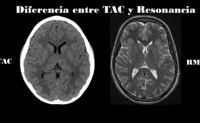 Conoce Las Diferencias Entre Una Tc Y Una Resonancia Otosection