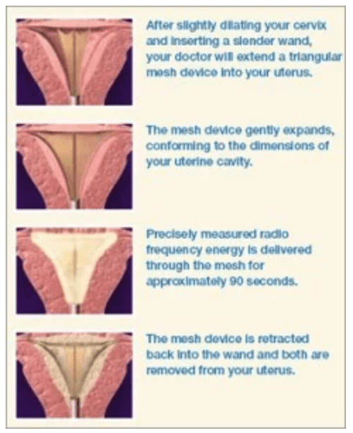 Endometrial Ablation Dr Basinski And Dr Juran Gynecologist Doctor