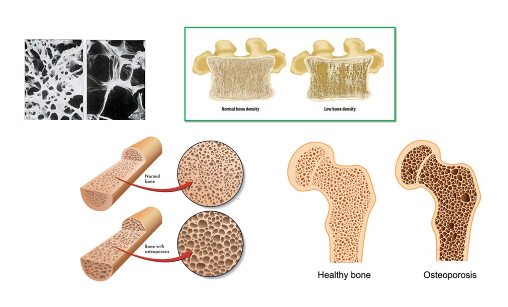 Bone Density Scale Chart