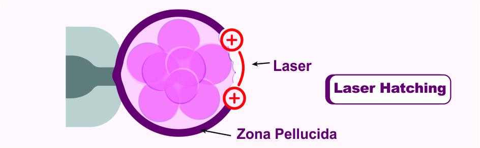 Laser Assisted Hatching Dreamz Ivf Best Ivf Clinic In Delhi Best