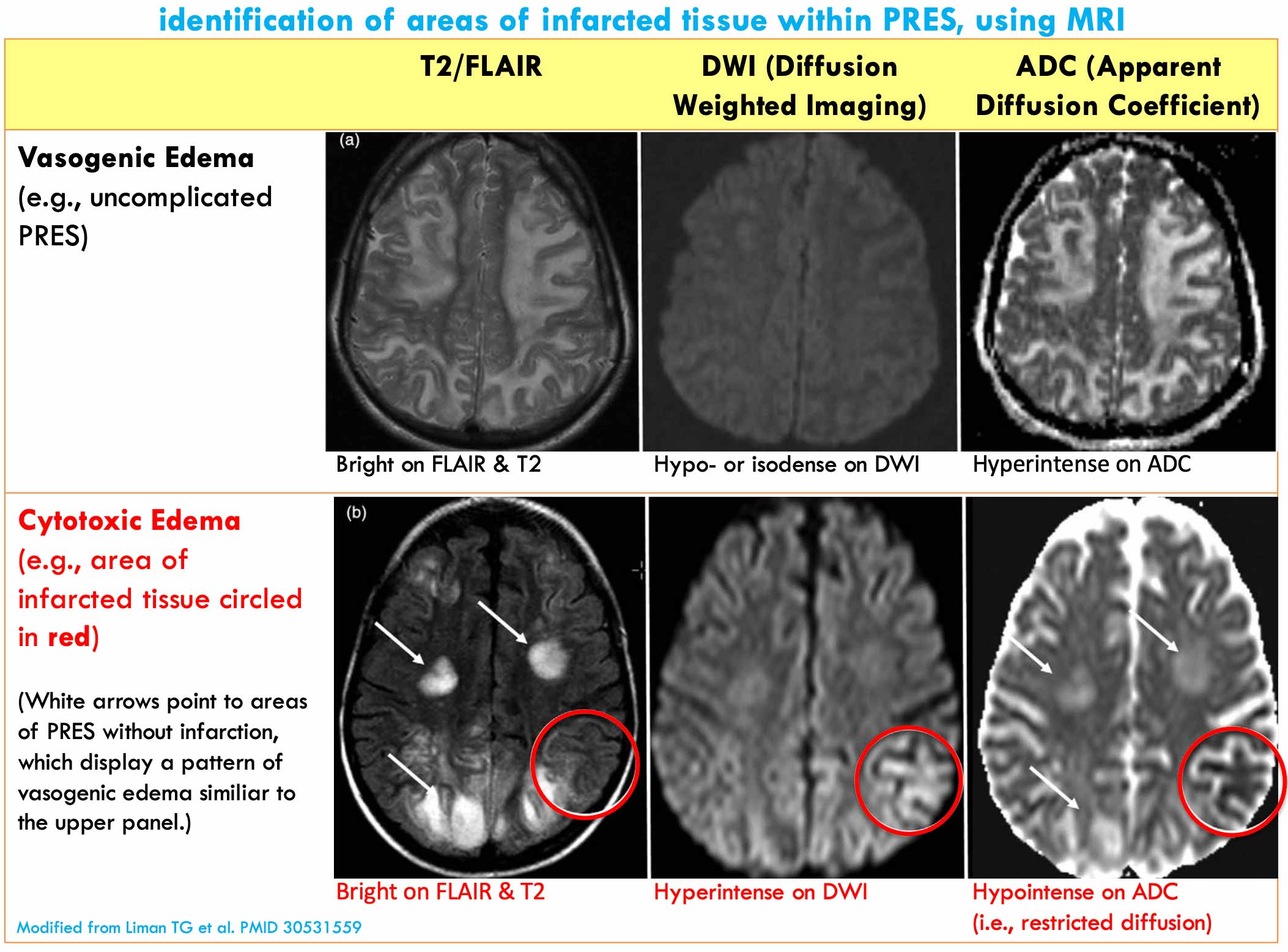 Posterior Reversible Encephalopathy Syndrome Pres Emcrit Project