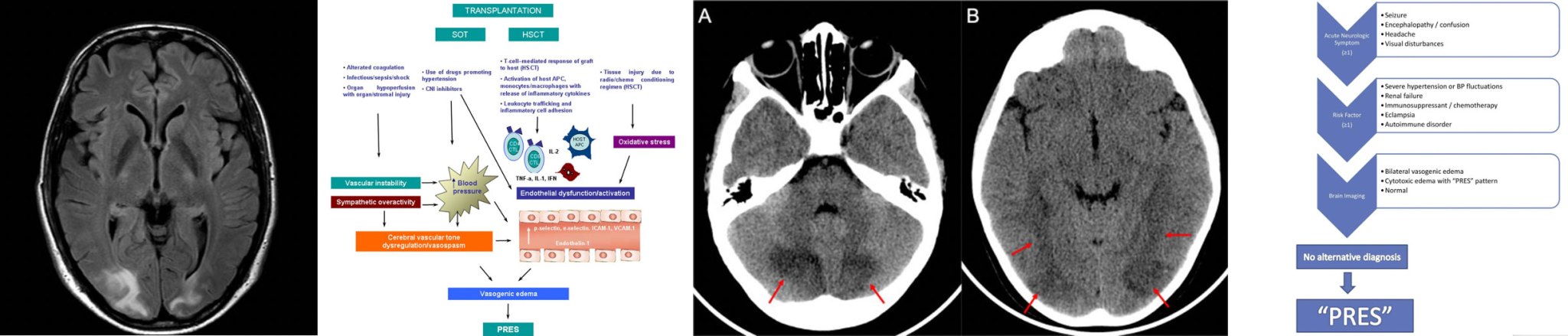 Posterior Reversible Encephalopathy Syndrome Pres Emcrit Project