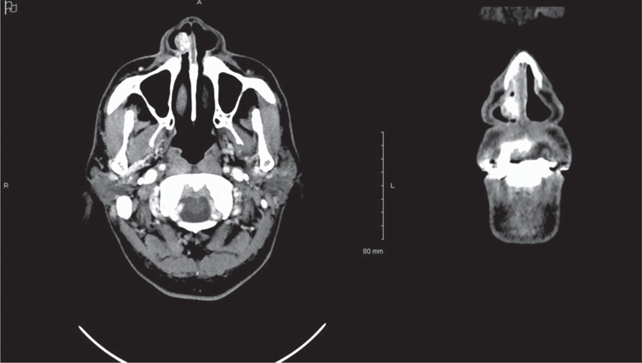 Benign Sinonasal Tumors Ento Key