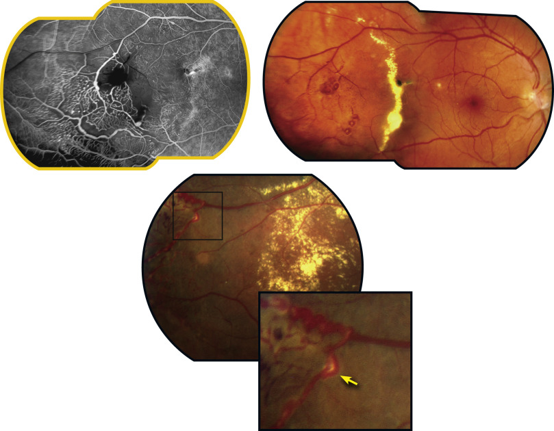 Retinal Vascular Disease Ento Key