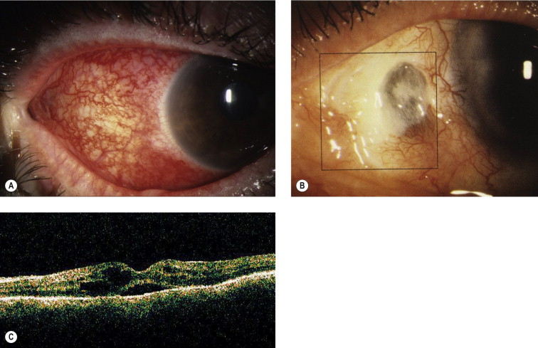 Scleritis Ento Key