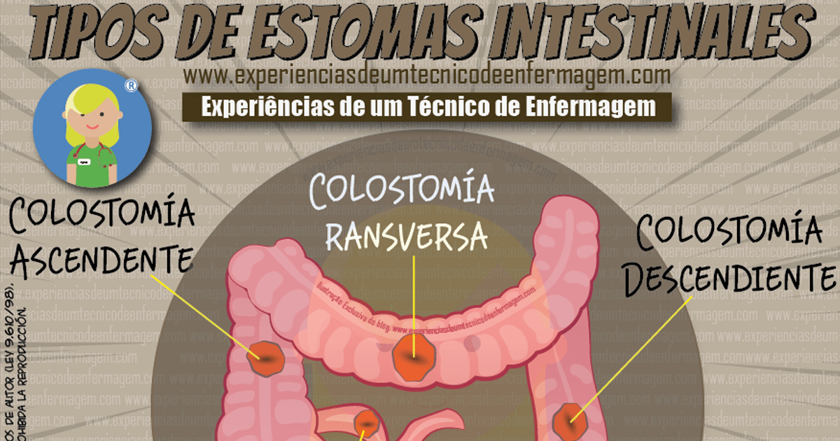 Estomas Intestinales Enfermagem Ilustrada