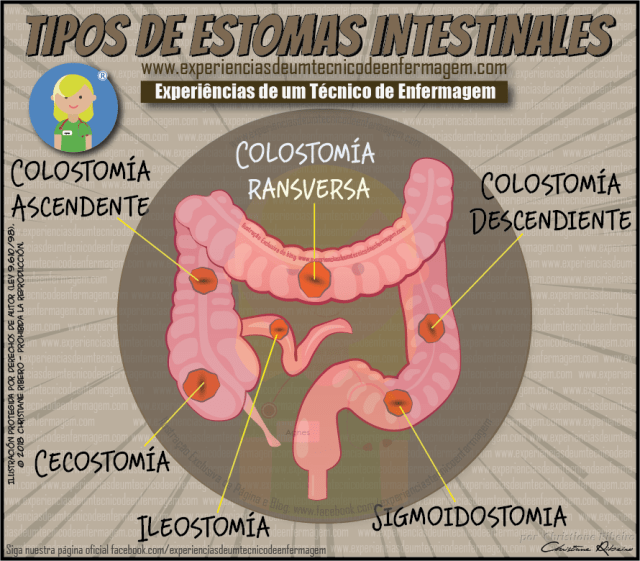 Estomas Intestinales Enfermagem Ilustrada